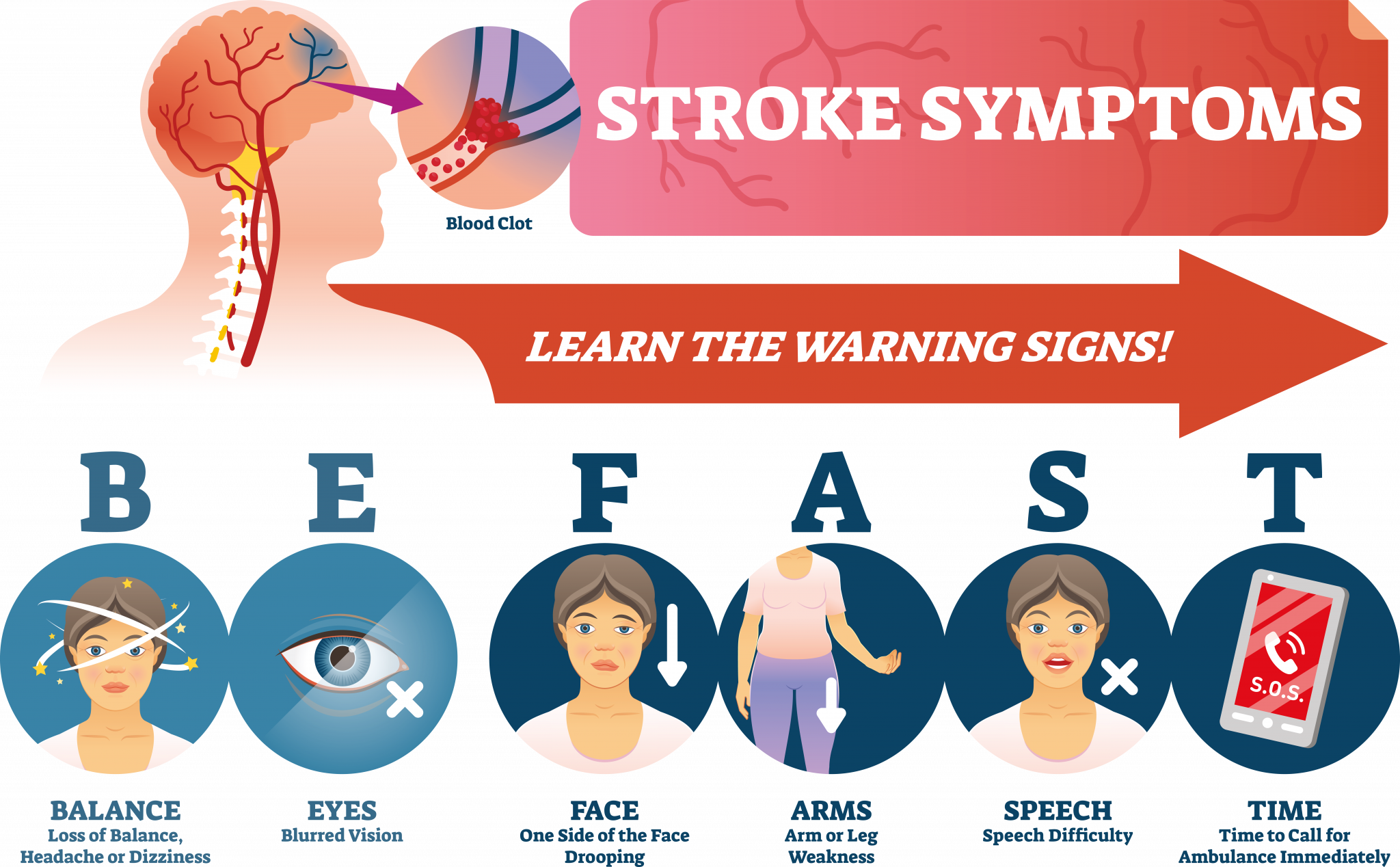 Stroke BEFAST High Peak First Aid Stroke BEFAST High Peak First Aid